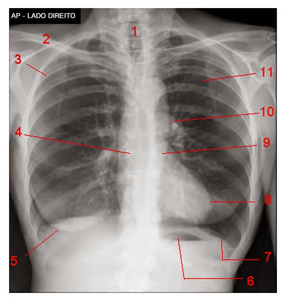 Radiologia na Web: Radiografia de Tórax - AP (Ântero Posterior) e ...