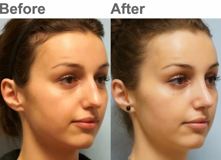 Facial Plastic Surgery: Cosmetic rhinoplasty, Dorsal hump, Tip rotation