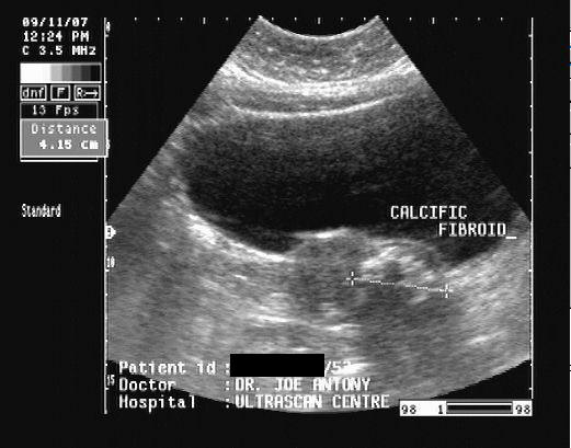 ON - RADIOLOGY: Sonography of fibroid with calcification