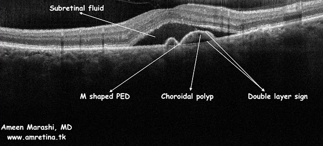 Polypoidal choroidal vasculopathy