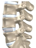 Dr Balaji Anvekar FRCR: Discectomy and Fusion Cage MRI