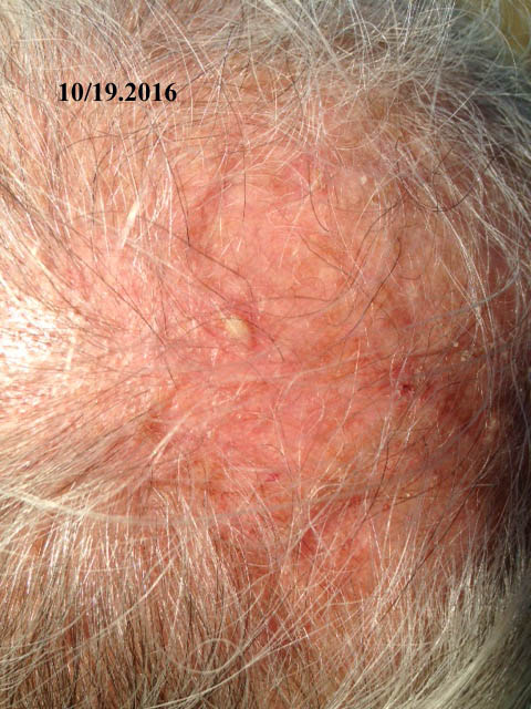 VIRTUAL GRAND ROUNDS IN DERMATOLOGY 2.0: 78 yo man with scalp lesions
