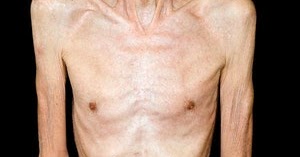 CACHEXIA (WASTING SYNDROME)