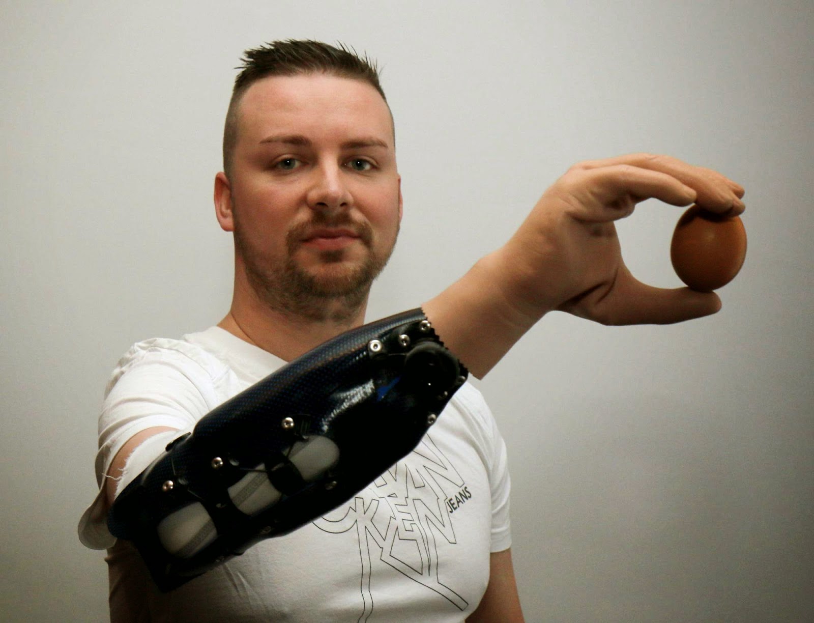 Tres hombres se hicieron amputar sus manos para ponersen prótesis biónicas