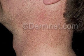 Family Medicine of Landsdowne Connection: Poikiloderma