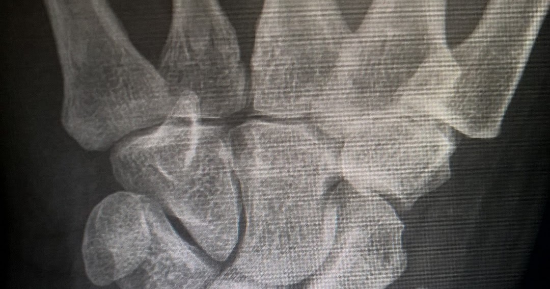 Patah Tulang (Fraktur): Jenis, Penyebab, Gejala, Pengobatan, Pencegahan