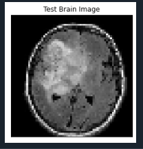 RareKind PhD Solutions: Brain Tumor Detection Using CNN with Python ...