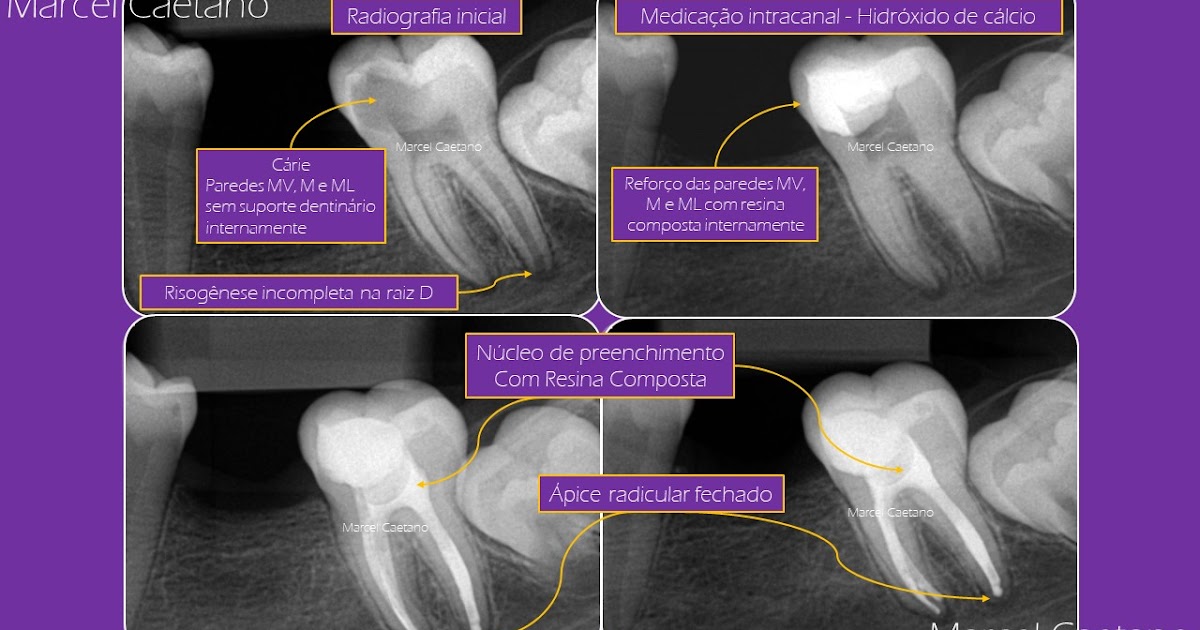 Endodontia Avançada: Tratamento endodôntico de dente com risogênese ...