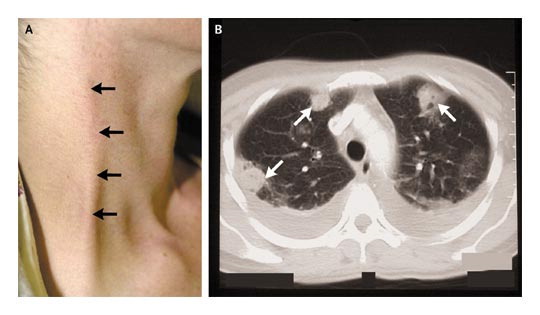 Tonsillitis Understood: Lemierre Syndrome
