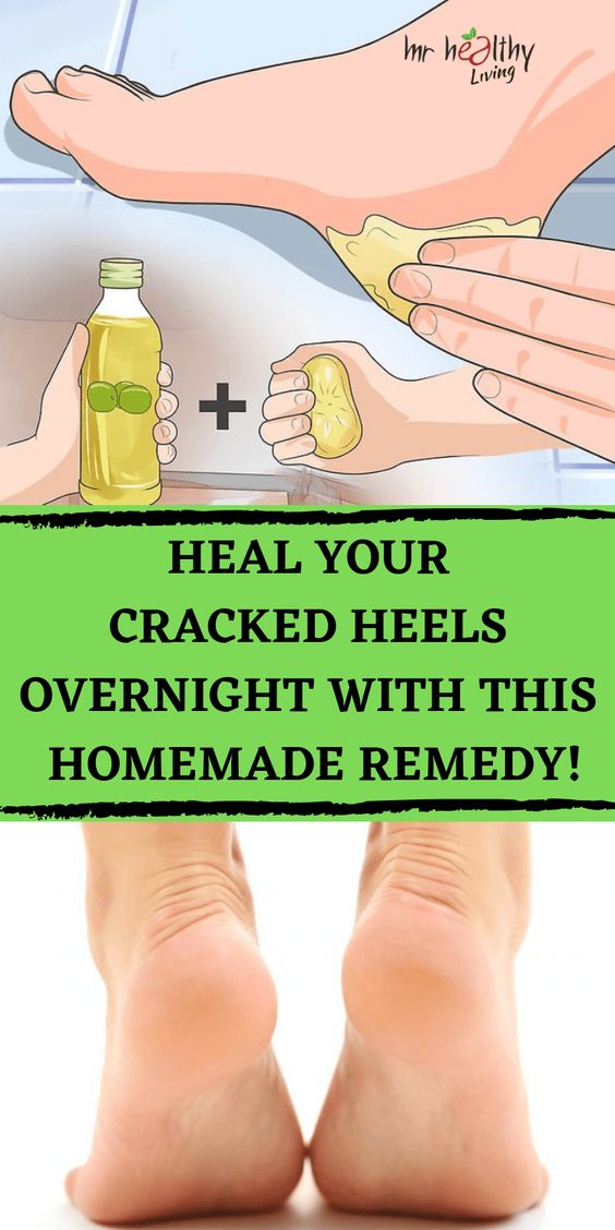 Say Stop To Your Cracked Heels With This Amazing Homemade Remedy ...
