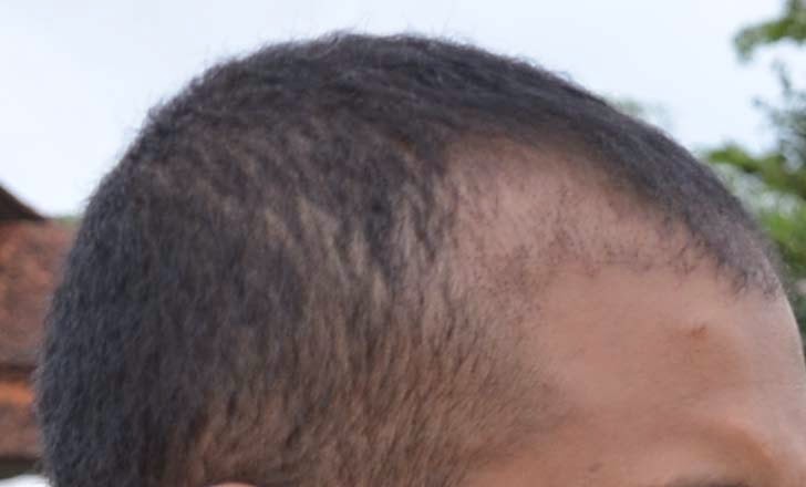 hair transplant experience - pengalaman transplantasi rambut / tanam ...