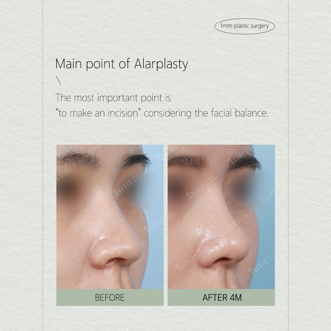 Blunt and Wide-looking Alar Base correction