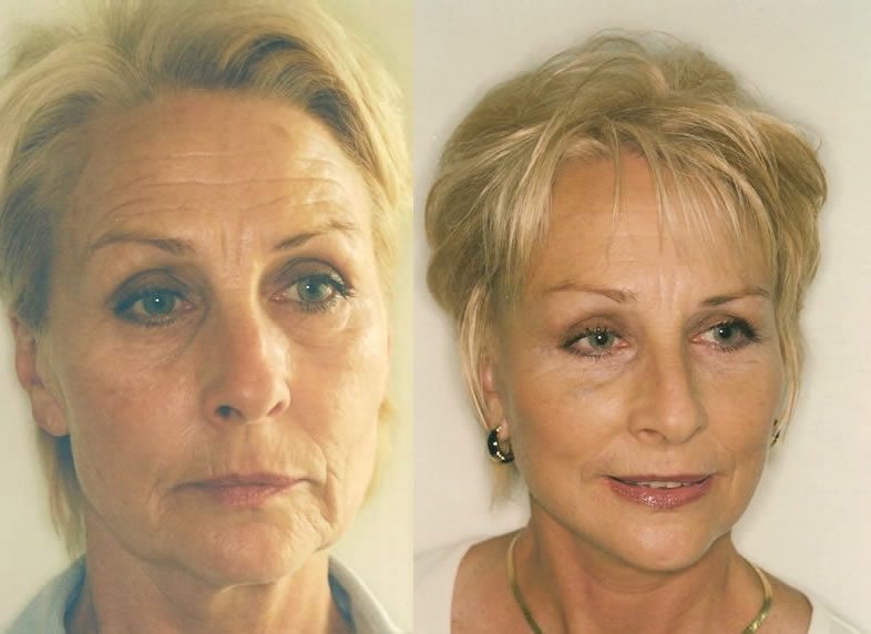 Exercising The Face For Skin Revitilization And Youth Retention