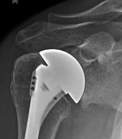 Shoulder Arthritis/Joint Replacement Rotator cuff tears: What is an ...