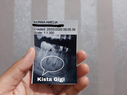 Operasi Kista Gigi | Kurnia Amelia