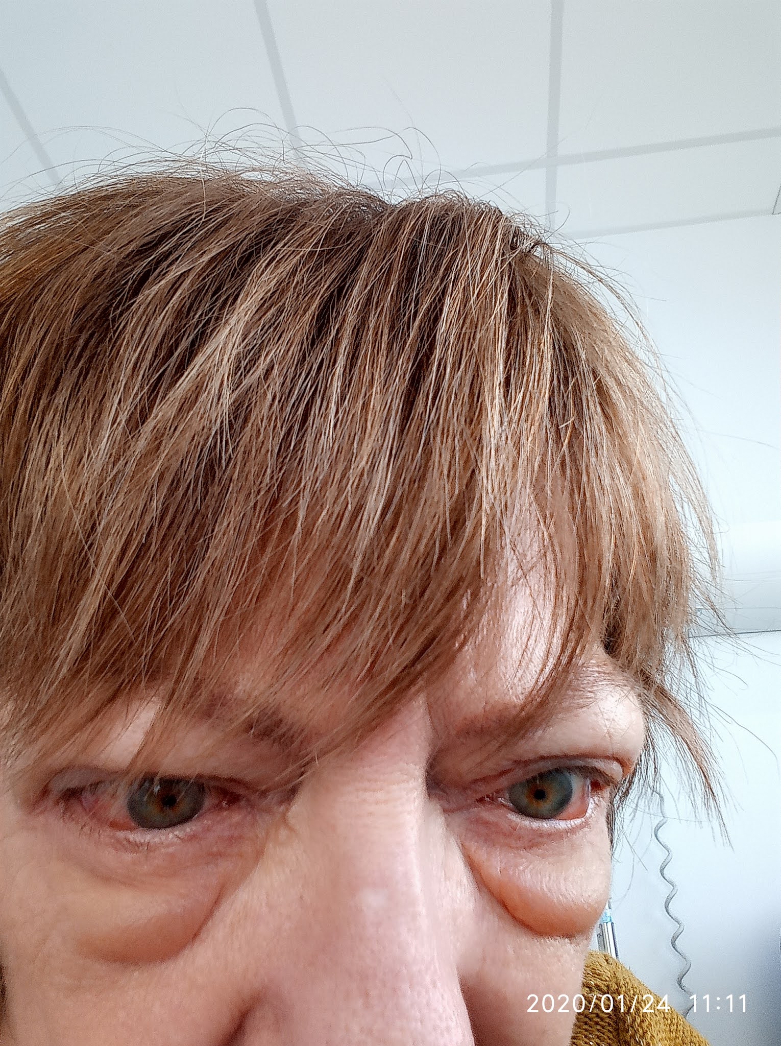 LA MALADIE DE BASEDOW