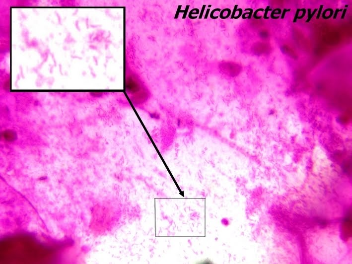 Fun With Microbiology (What's Buggin' You?): Helicobacter pylori