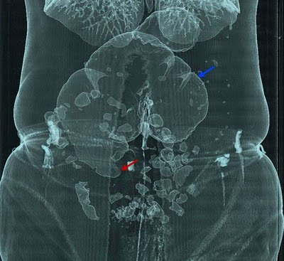 BLOG SCAN - RA Radiologistas Associados: VOLVULO DO COLON SIGMOIDE