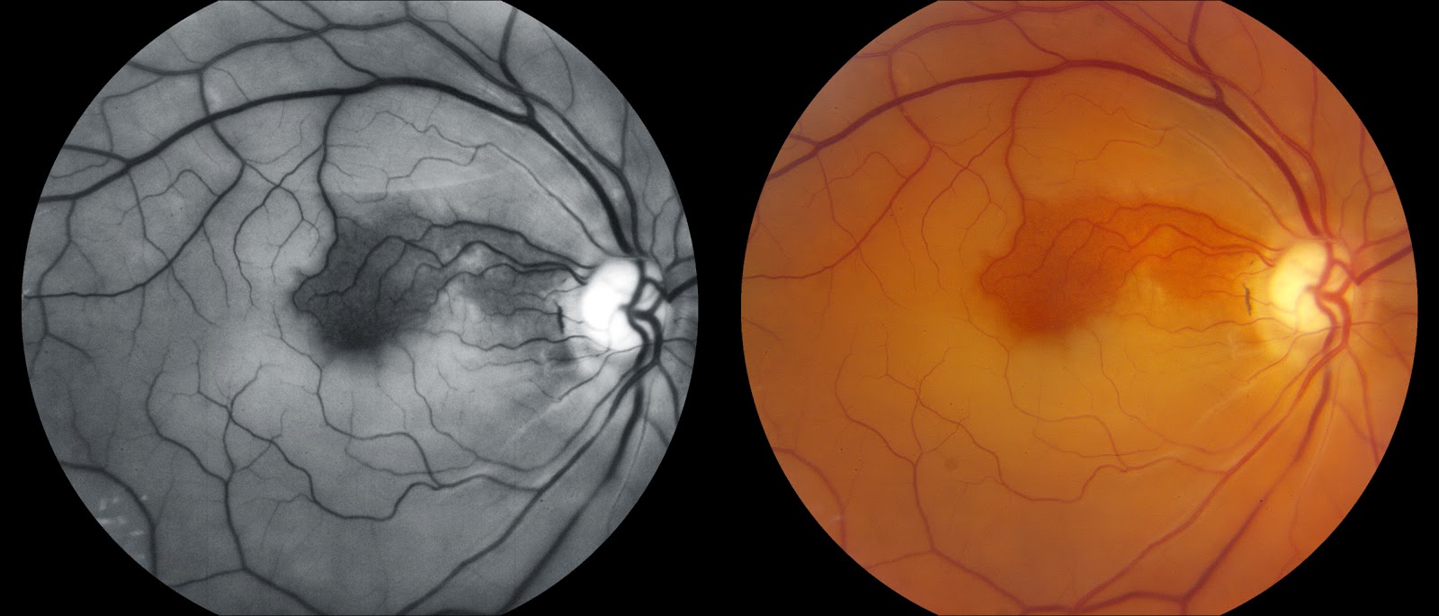 Whitman Images: CRAO: Central Retinal Artery Occlusion