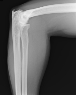 Olecranon Spur-Plain Film - Sumer's Radiology Blog