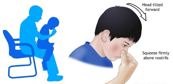 nose bleed(epistaxis) ,how to manage?