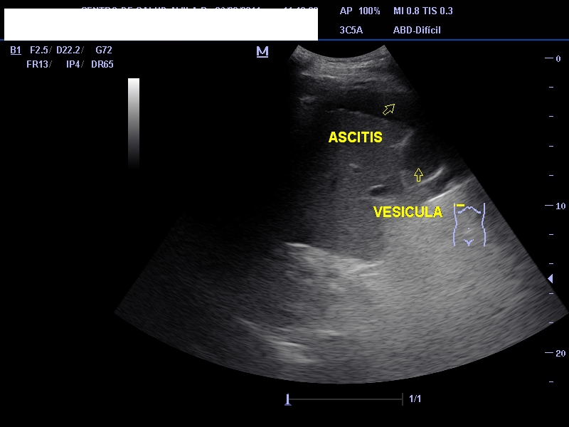EcoCyl-Grupo: Ascitis