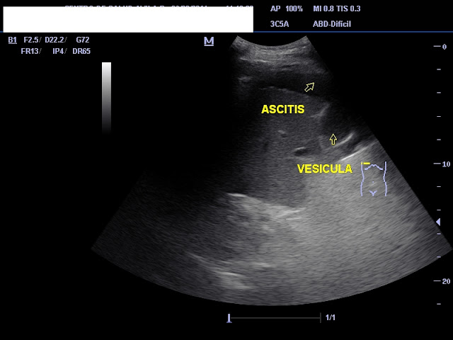 EcoCyl-Grupo: Ascitis
