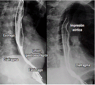 Protocolos De Imagenologia: ESOFAGOGRAMA