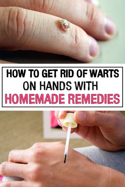 How to Get Rid of Warts on Hands with Homemade Remedies - medicine ...