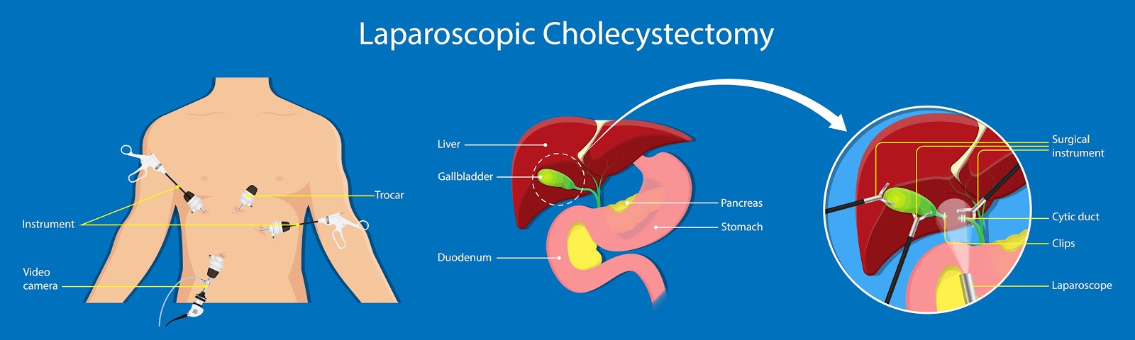 Real Psychiatry: The Laparoscopic Cholecystectomy