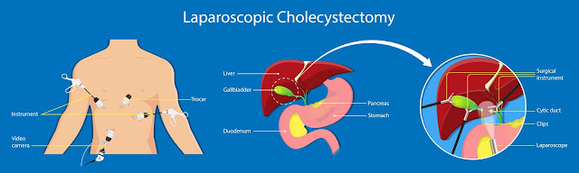 Real Psychiatry: The Laparoscopic Cholecystectomy