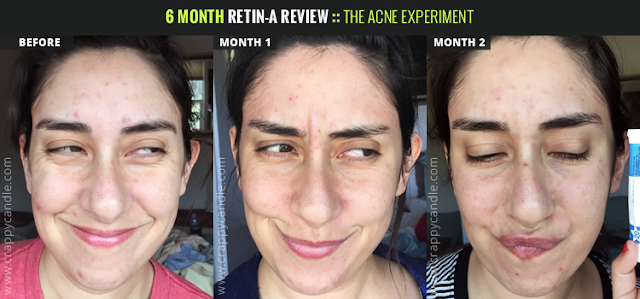 6 Month Retin-A Review - The Acne Experiment | Crappy Candle