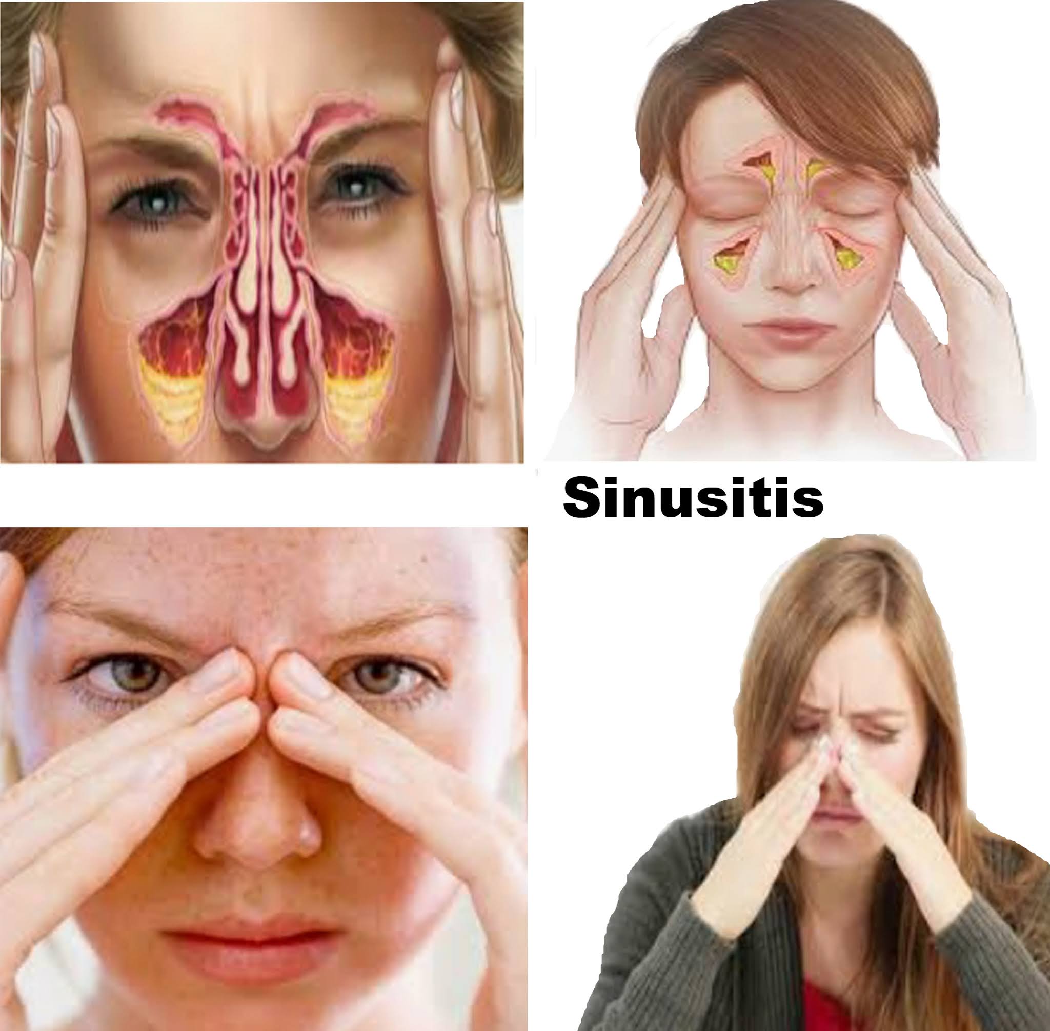 Sinusitis: Types, Symptoms, Test, Prevention, and Treatment.