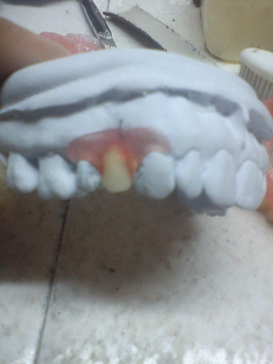 Gigi palsu/ tiruan lepasan Flexyble Valplast ~ Ahli nya Gigi Palsu di ...