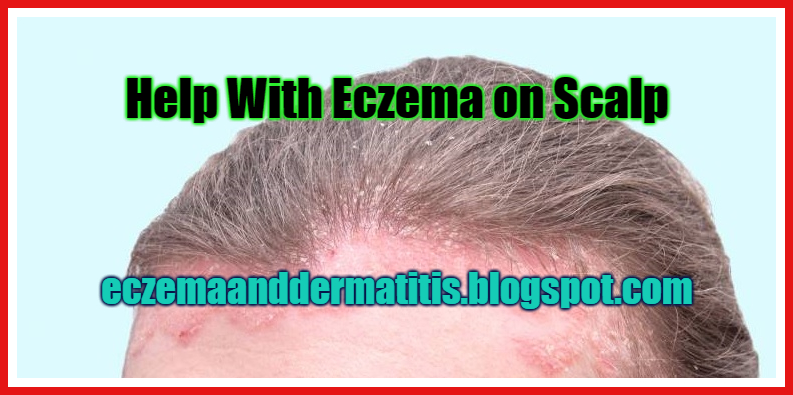 Help With Eczema On Scalp Eczema And Dermatitis