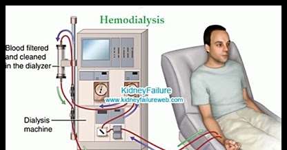 Bagaimana cara kerja alat cuci darah ( hemodialisa ), ini penjelasannya ...