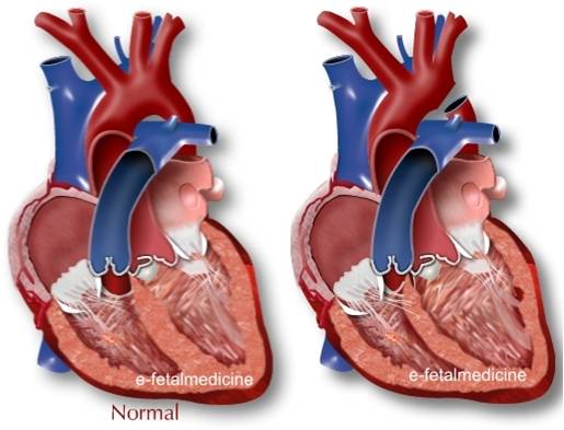 CHD: 24. ПРЕКИНАТ АОРТЕН ЛАК ( IAA)