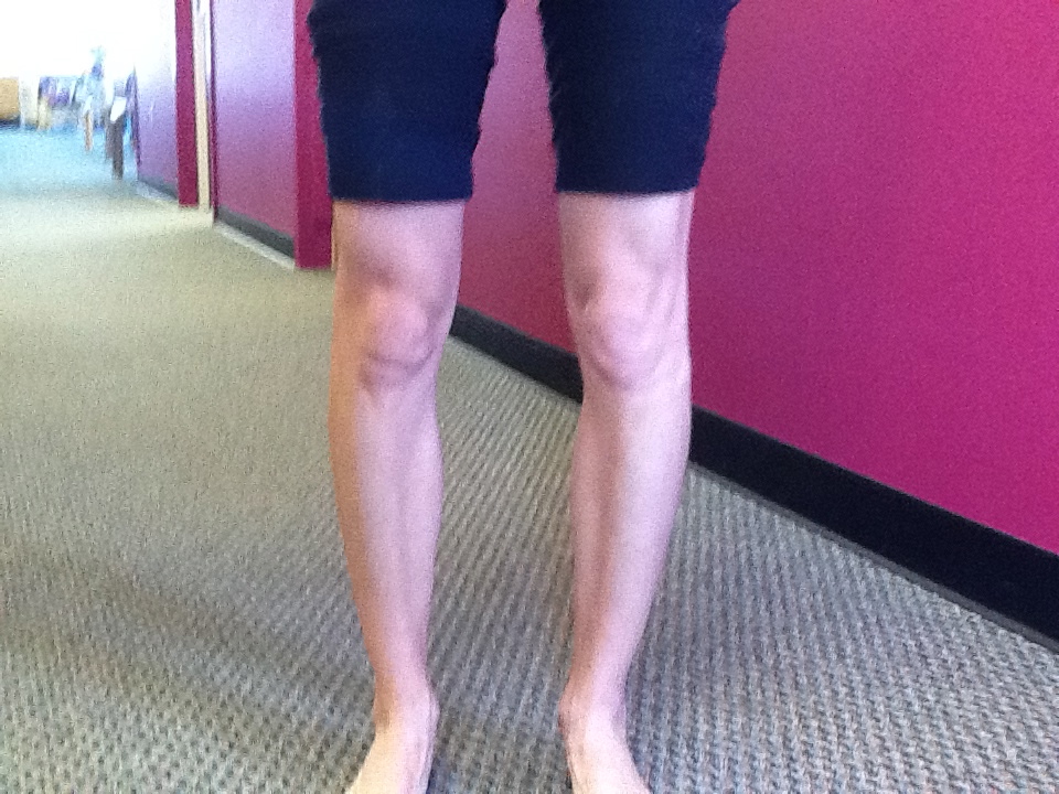 Foot And Ankle Problems By Dr Richard Blake Do You See The Knee Alignment Problem On The Left