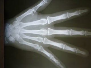 Rx011: Proyecciones Mano
