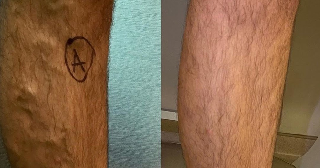 Varis Cerrahisi: Varis nedir? Neden oluşur?