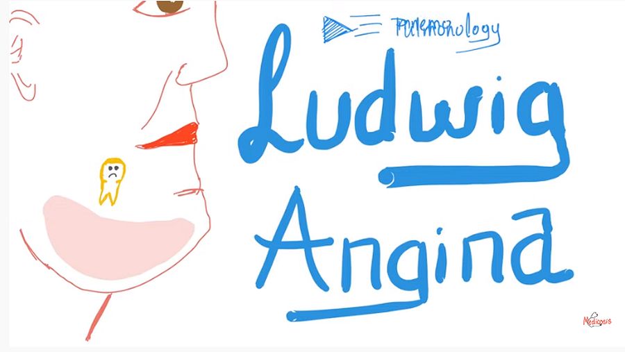 LUDWIG ANGINA: Causes, Clinical Picture, Diagnosis and Management ...