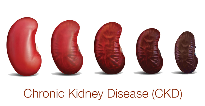 CKD (CHRONIC KIDNEY DISEASE)
