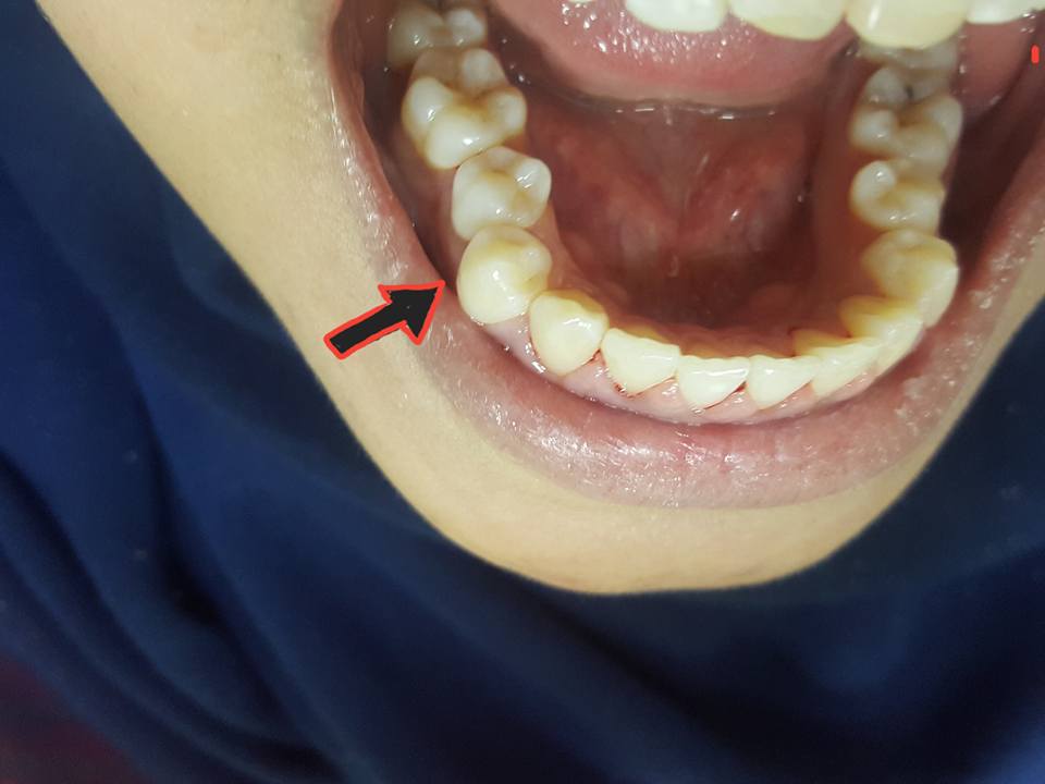 Saya Tanya Kenapa Sejak Pakai Braces, Gigi Saya Sakit Dan Makin ...