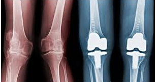 Medical Treatment in India: The benefits with minimally invasive knee ...