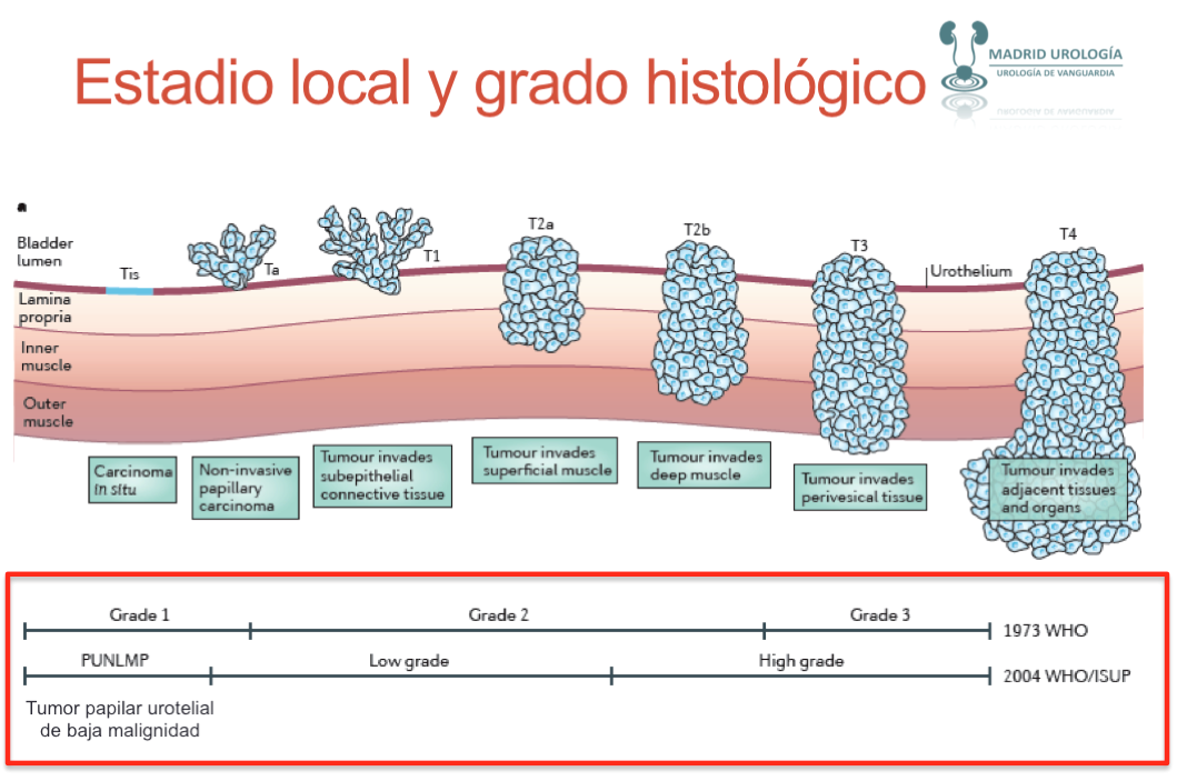 Madrid Urología: Cáncer de Vejiga. Histología 1. MU. Capítulo 2.