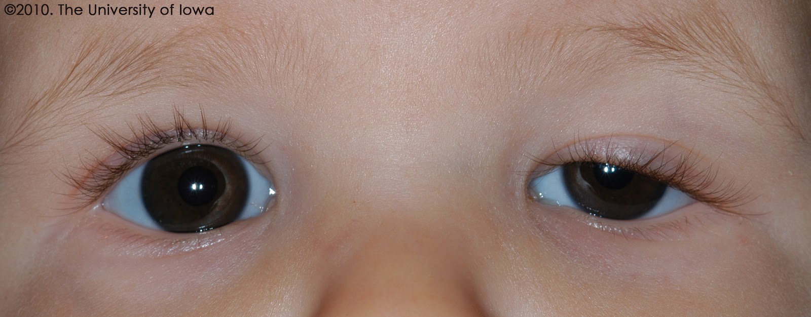 PTOSIS in Children and Adults
