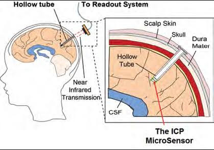 INTRA CRANIAL PRESSURE MONITORING - Nurses note help