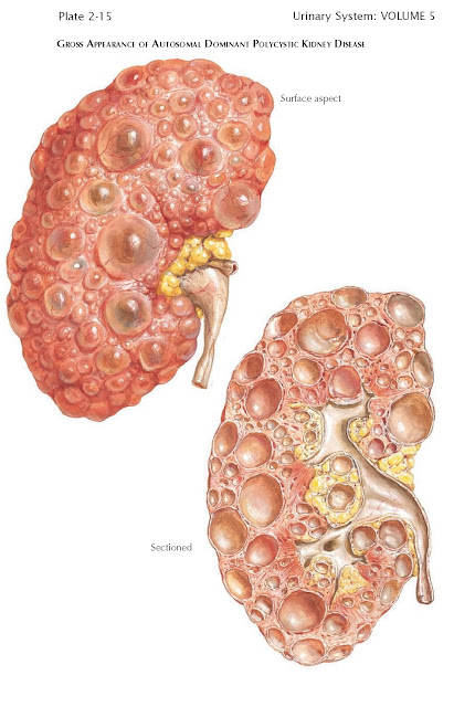 POLYCYSTIC KIDNEY DISEASE - pediagenosis