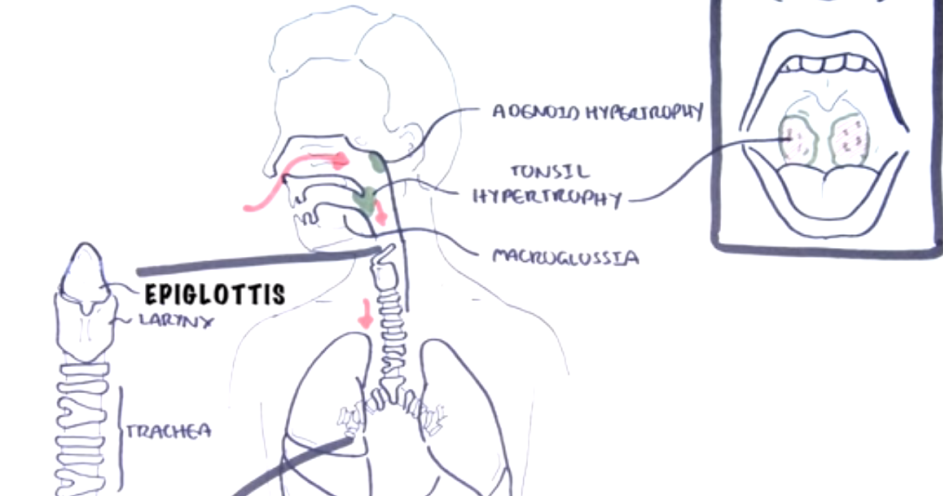Stridor| definition, causes, types and clinical picture