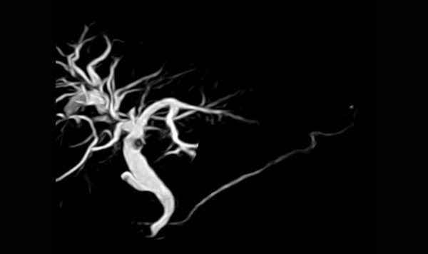 Colangioresonancia y vías biliares - Criterios técnicos